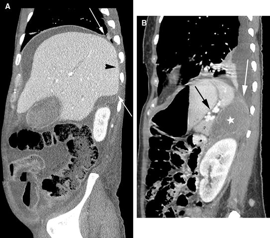 The subperitoneal space and peritoneal cavity: basic concepts ...