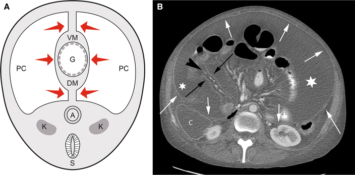 The subperitoneal space and peritoneal cavity: basic concepts ...