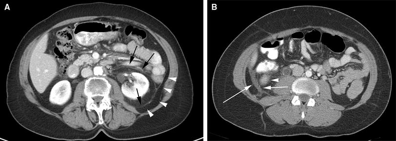 The subperitoneal space and peritoneal cavity: basic concepts ...