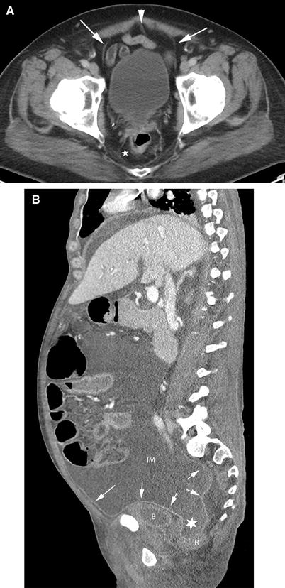 The subperitoneal space and peritoneal cavity: basic concepts ...