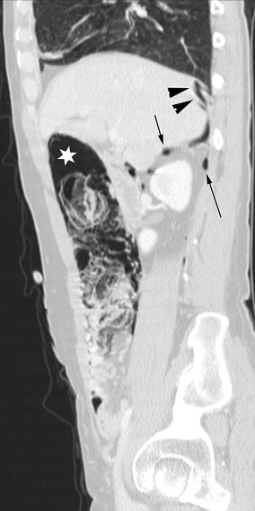 The subperitoneal space and peritoneal cavity: basic concepts ...
