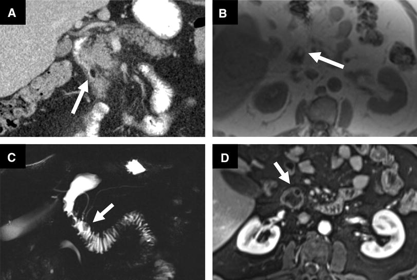 MDCT and MRI of the ampulla of Vater (part II): non-epithelial ...