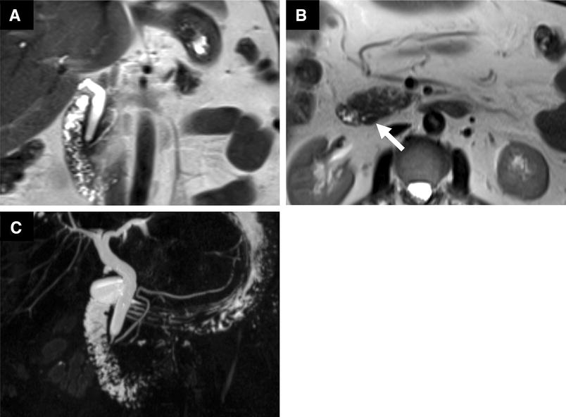 MDCT and MRI of the ampulla of Vater (part II): non-epithelial ...