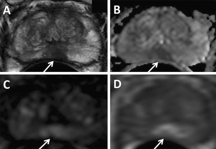 DCE MRI of prostate cancer | SpringerLink