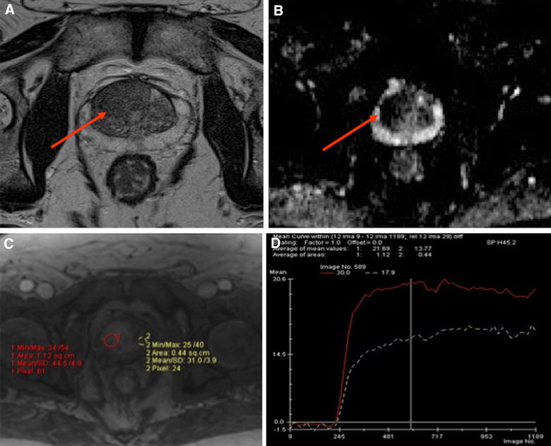 DCE MRI of prostate cancer | SpringerLink
