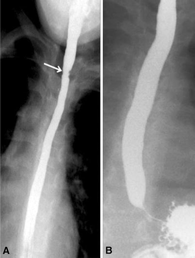 How does esophagus look on barium esophagram in pediatric eosinophilic esophagitis? | SpringerLink