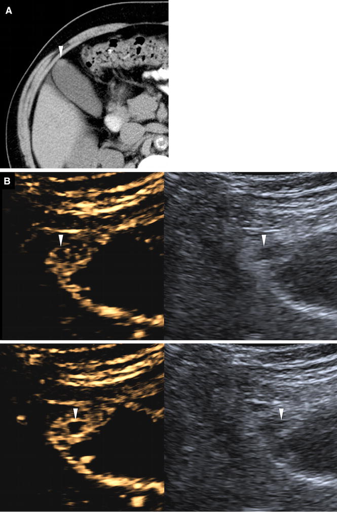 Contrast-enhanced ultrasound in gallbladder disease: a pictorial review ...