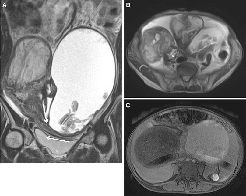 A case of uterine torsion concurrent with a ruptured ovarian ...