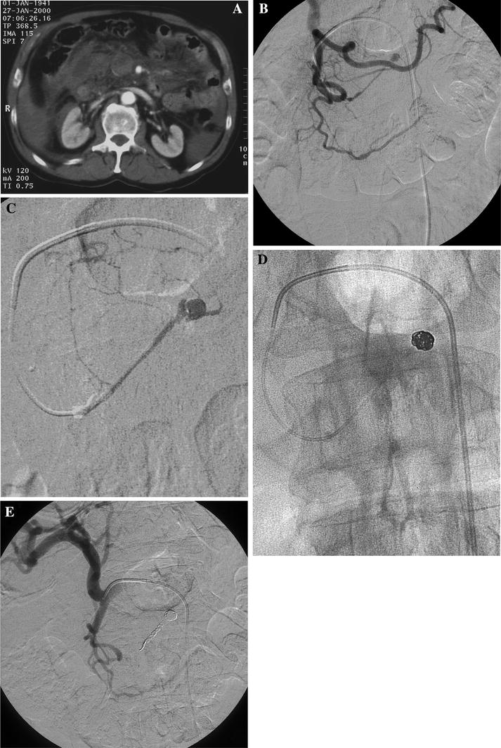 Superselective transcatheter arterial embolization in patients with ...