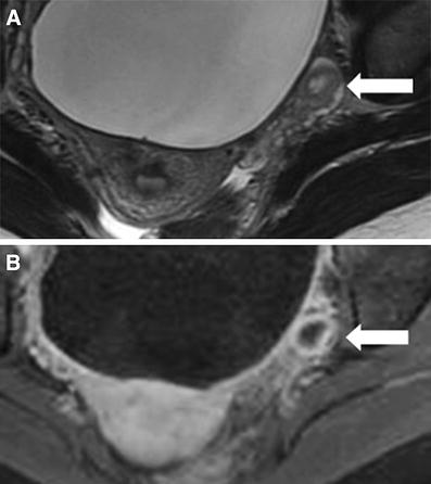 Radiological appearances of corpus luteum cysts and their imaging ...