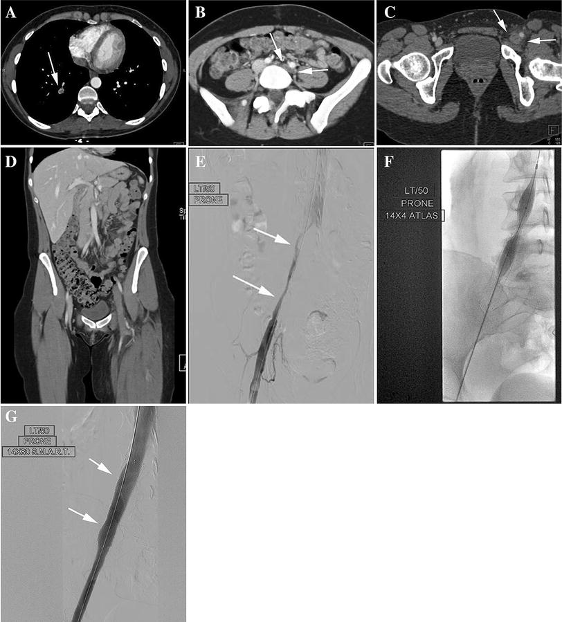 May–Thurner syndrome: MDCT findings and clinical correlates | SpringerLink