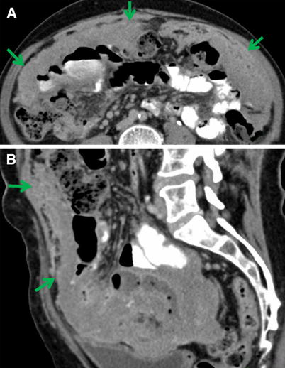 Omental cake | SpringerLink