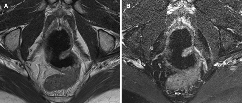 MRI characteristics of proctitis in Crohn’s disease on perianal MRI ...