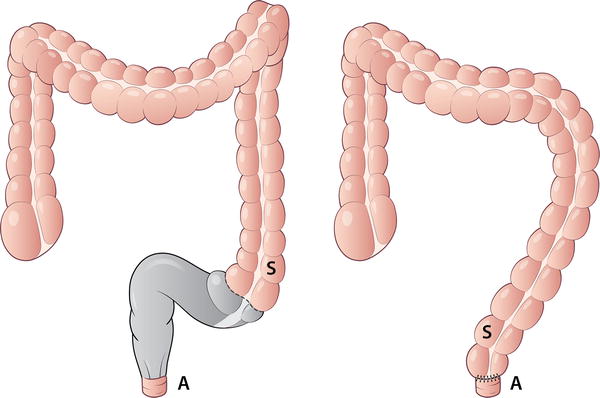 Post-operative colon and urinary diversions: surgical techniques ...