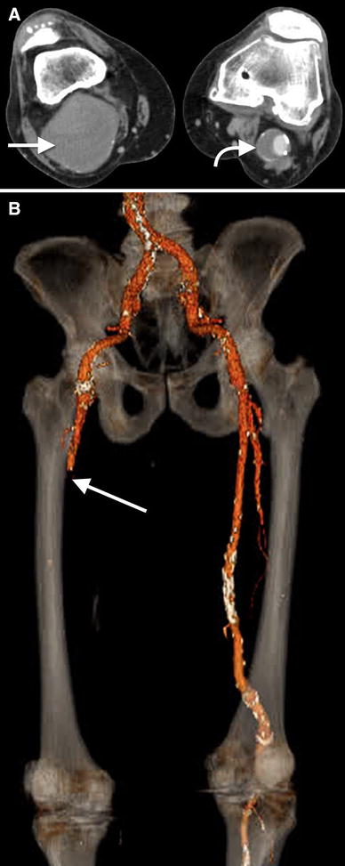 Role of lower extremity run-off CT angiography in the evaluation of ...