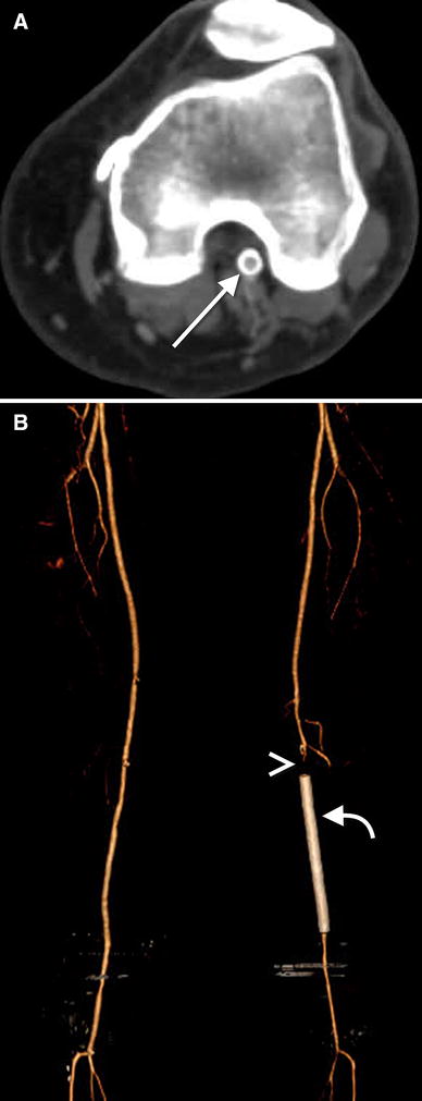 Role of lower extremity run-off CT angiography in the evaluation of ...