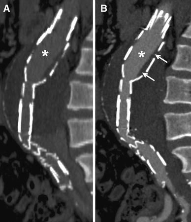 Role of lower extremity run-off CT angiography in the evaluation of ...
