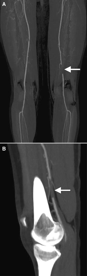 Role of lower extremity run-off CT angiography in the evaluation of ...