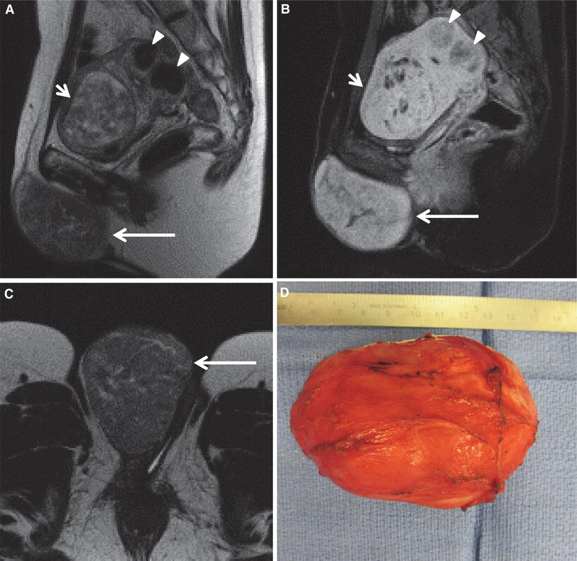 MR imaging of atypical fibroids | SpringerLink