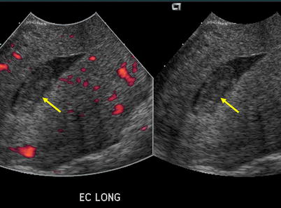 Clinical and imaging predictors of management in retained products of ...