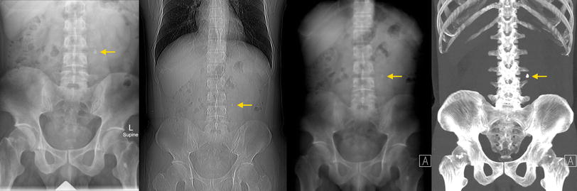 Alternatives to the baseline KUB for CTKUB-detected calculi: evaluation ...