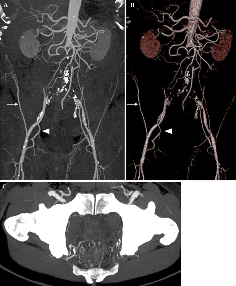 CT angiography and 3D imaging in aortoiliac occlusive disease ...