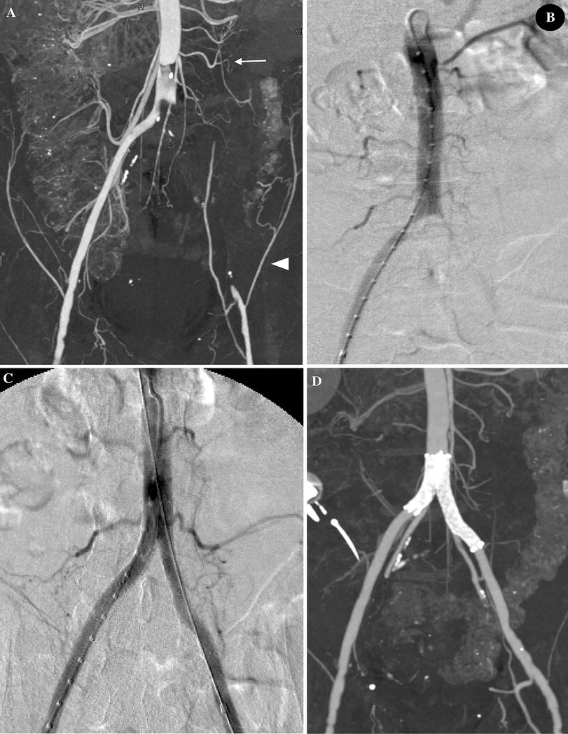 CT angiography and 3D imaging in aortoiliac occlusive disease ...