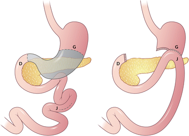 Gastroduodenal and pancreatic surgeries: indications, surgical ...