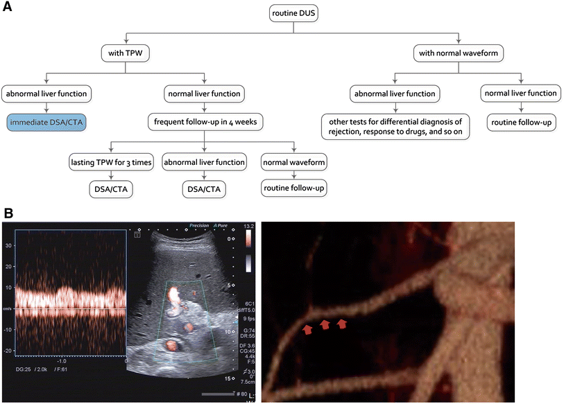 Tardus parvus waveforms in Doppler ultrasonography for hepatic artery ...