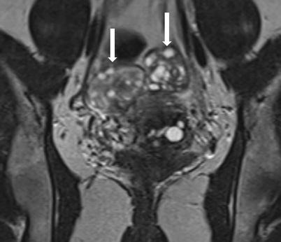 Kissing ovaries sign on MRI | SpringerLink