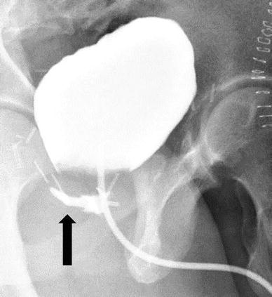 Voiding cystourethrography after prostatectomy: spectrum of appearances ...