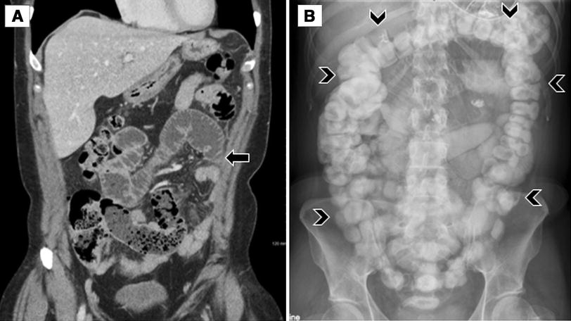 Small bowel obstruction and the gastrografin challenge | SpringerLink