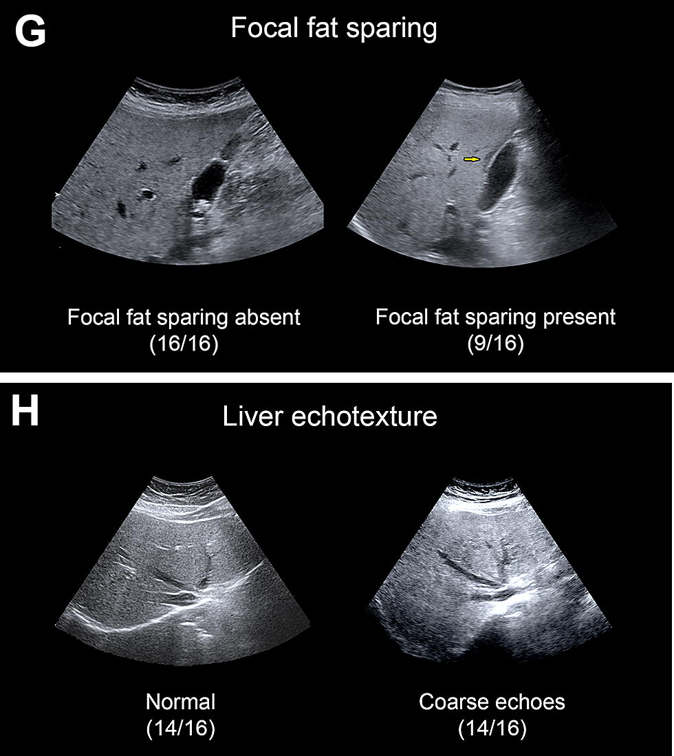 Reader agreement and accuracy of ultrasound features for hepatic ...