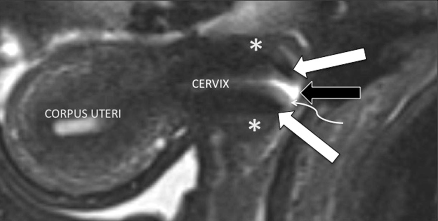 MRI of cervical cancer with a surgical perspective: staging, prognostic ...