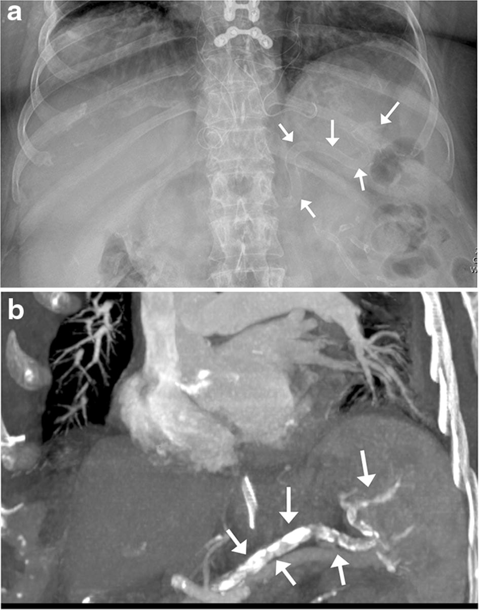 Chinese dragon sign: splenic artery calcification | SpringerLink