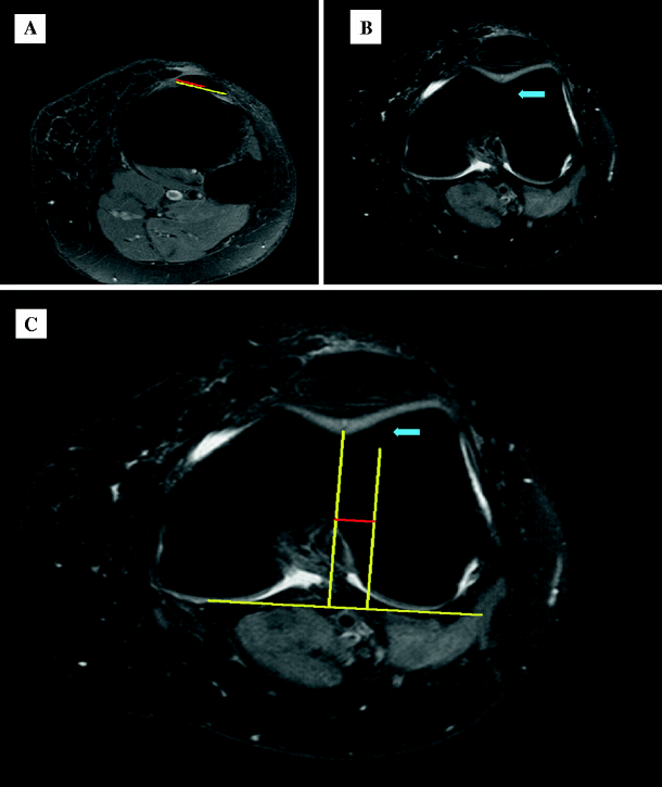 Magnetic resonance imaging assessment of tibial tuberosity–trochlear ...