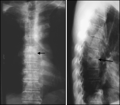 Pyogenic spondylitis | SpringerLink