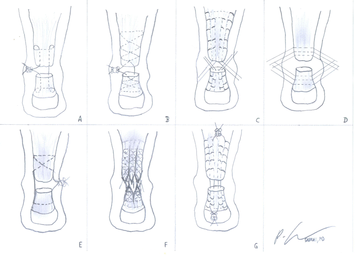 Initial Achilles tendon repair strength—synthesized biomechanical data ...