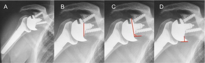 The use of an eccentric glenosphere compared with a concentric ...