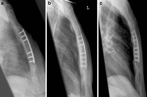 Surgical fixation of sternal fractures: locked plate fixation by low ...