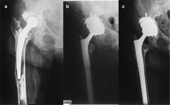 Acetabular revision arthroplasty using trabecular titanium implants ...