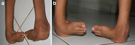 Feasibility and barriers of treating clubfeet in four countries ...