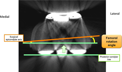 Is computed tomography an accurate and reliable method for measuring ...
