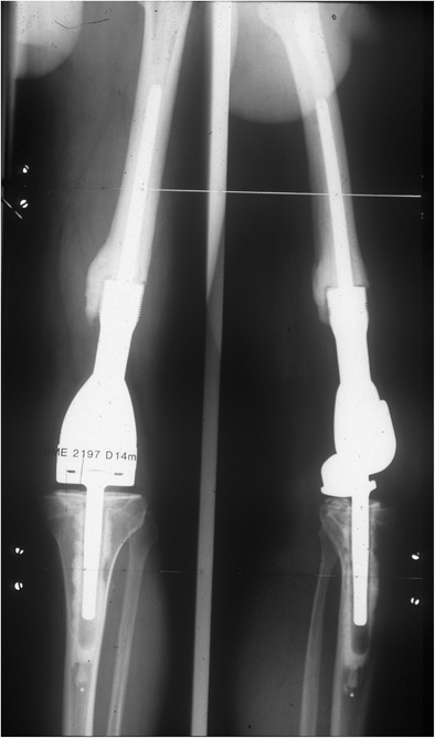 The use of megaprosthesis in the treatment of periprosthetic knee ...
