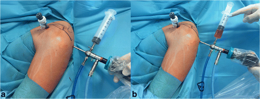 Effect of arthroscopic techniques on joint volume in shoulder ...