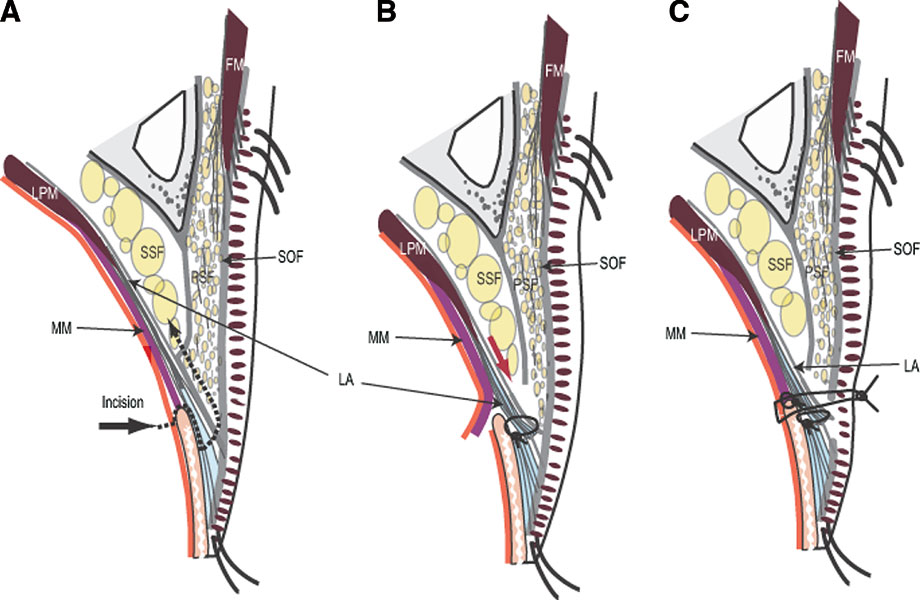 Transconjunctival Levator Aponeurotic Repair Without Resection of ...