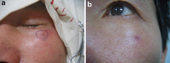 A New Procedure for Treating a Sebaceous Cyst: Removal of the Cyst ...