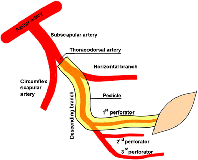 Experience Using the Thoracodorsal Artery Perforator Flap in Axillary ...
