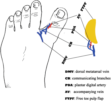 Digital Pulp Reconstruction with Free Neurovascular Toe Flaps ...