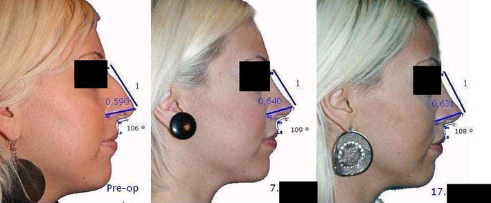 Comparison of the Effects of Columellar Strut and Septal Extension ...